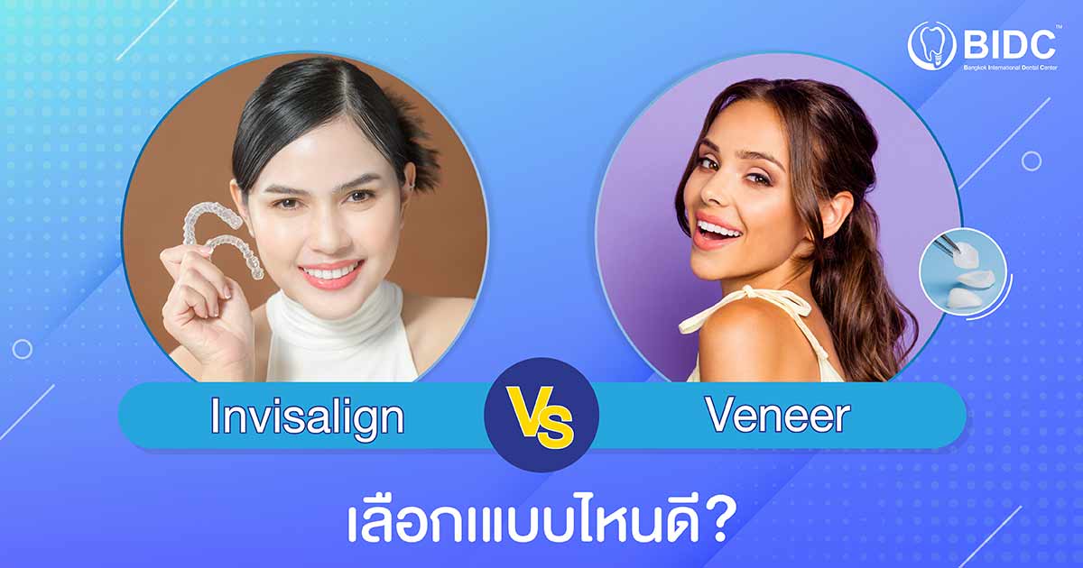 จัดฟันใส Invisalign VS วีเนียร์ เลือกทำฟันสวยแบบไหนดี ? | BIDC